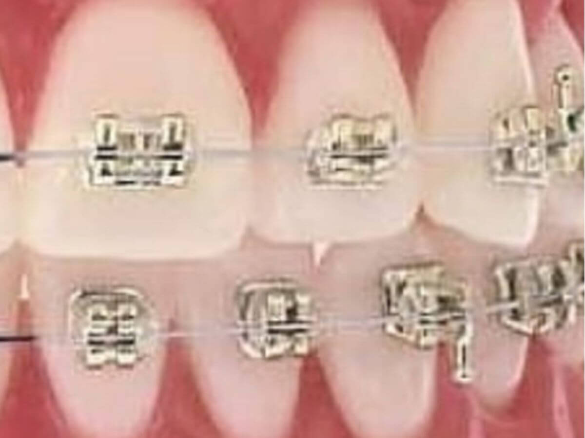 Best Dentist for Braces (KL) Kuala Lumpur | Hello Dental