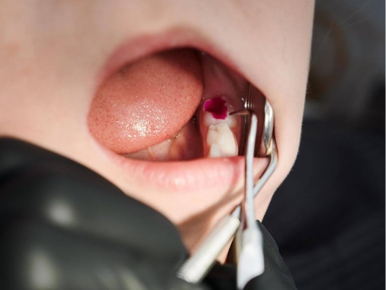 Fillings & Scaling and Polishing in Malaysia | Hello Dental