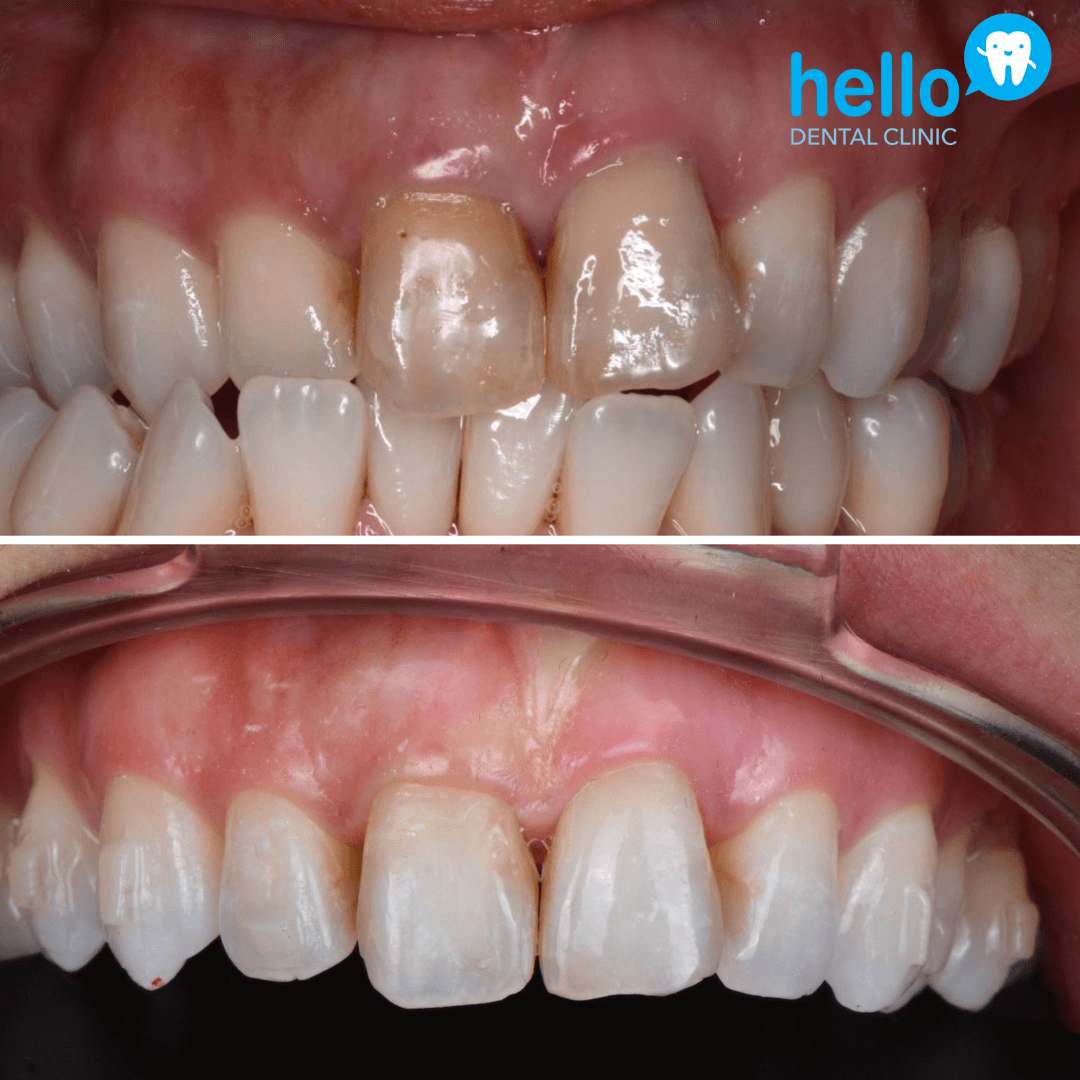 Dentist for Teeth Whitening (KL) Kuala Lumpur | Hello Dental