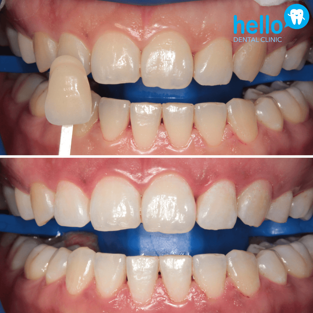 Dentist for Teeth Whitening (KL) Kuala Lumpur | Hello Dental
