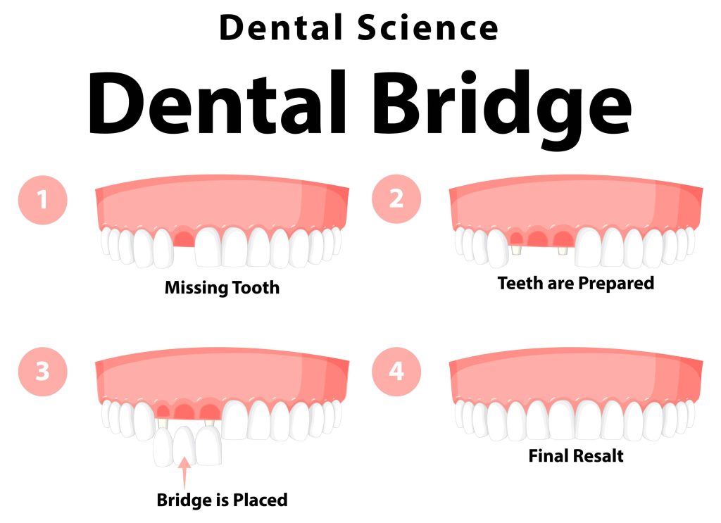 Different Types of Dental Bridges in Malaysia | Hello Dental