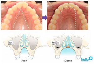 Normal Tongue vs Tongue Tie | Hello Dental Clinic