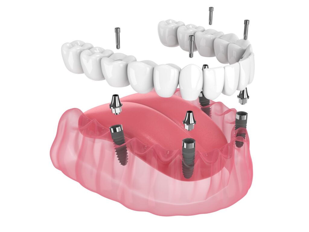 All-On-4 Dental Implants: What You Need to Know | Hello Dental