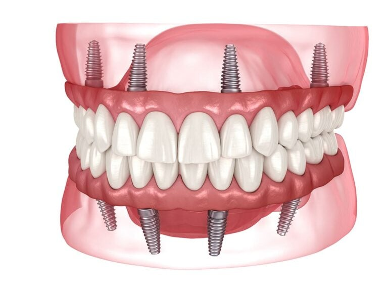 All-On-4 Dental Implants: What You Need to Know | Hello Dental