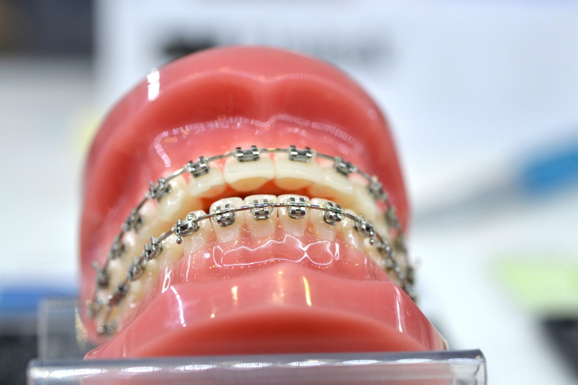 Braces Price in Malaysia – Types, Costs & Key Considerations