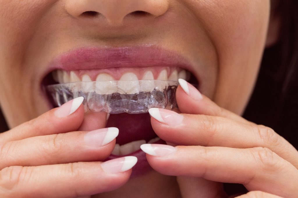 8 Simple Ways to Stop Teeth Grinding & Protect Your Smile